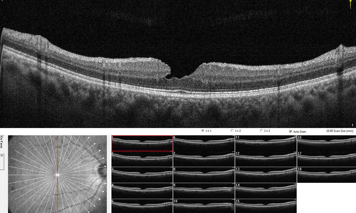 Pucker e Foro Maculare - Poliambulatorio Oculistico Salus